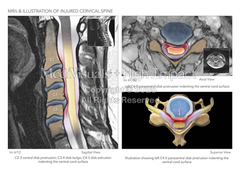 MRIs & Illustration of Injured Cervical Spine | MediVisuals + High Impact