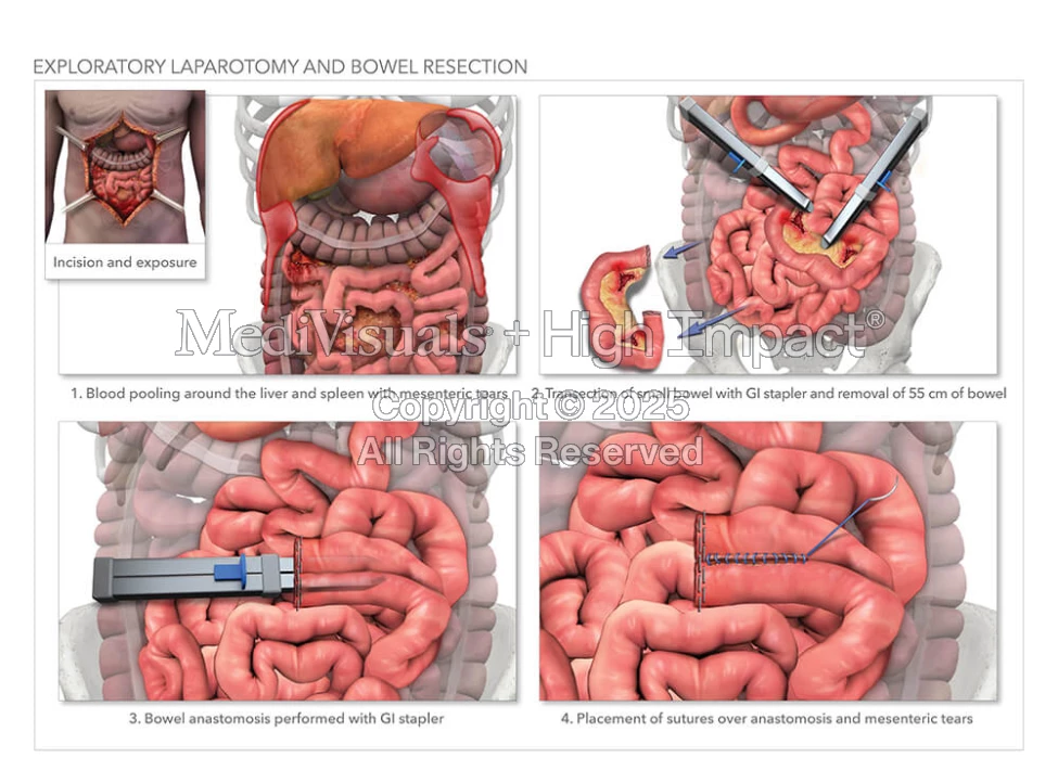 Medical Illustration-Surgery Illustration | MediVisuals + High Impact