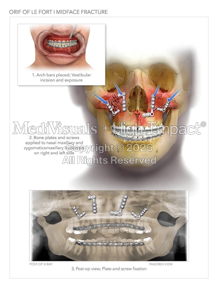 ORIF of Le Fort I Midface Fracture