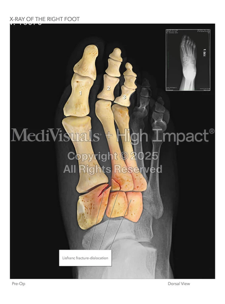 Medical Legal Art Showing Foot Injury