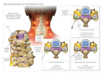 Cervical Injury Summary | MediVisuals + High Impact