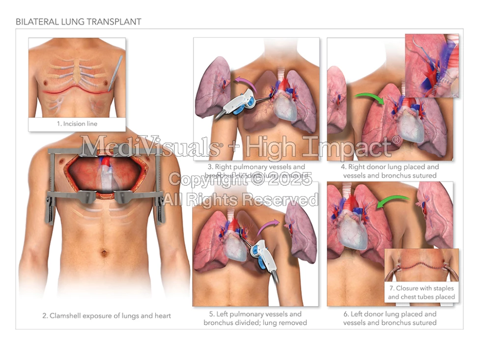 bilateral-lung-transplant-medivisuals-high-impact