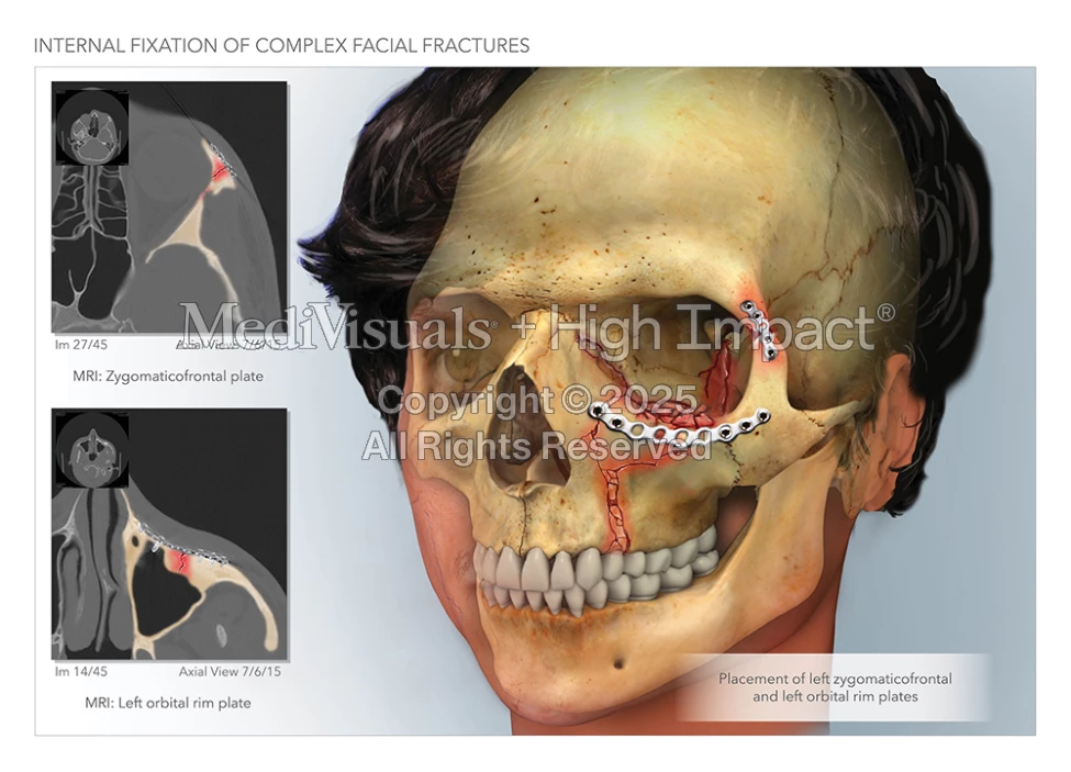 Internal Fixation of Complex Facial Fractures | MediVisuals + High Impact