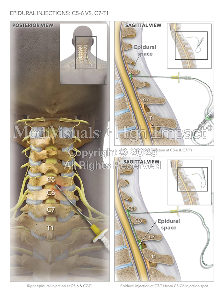 Epidural Injections C5-6 vs. C7-T1 | MediVisuals + High Impact