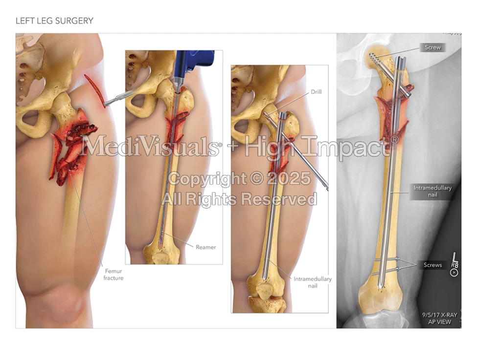 Intramedullary Nailing of Femur Fracture | MediVisuals + High Impact