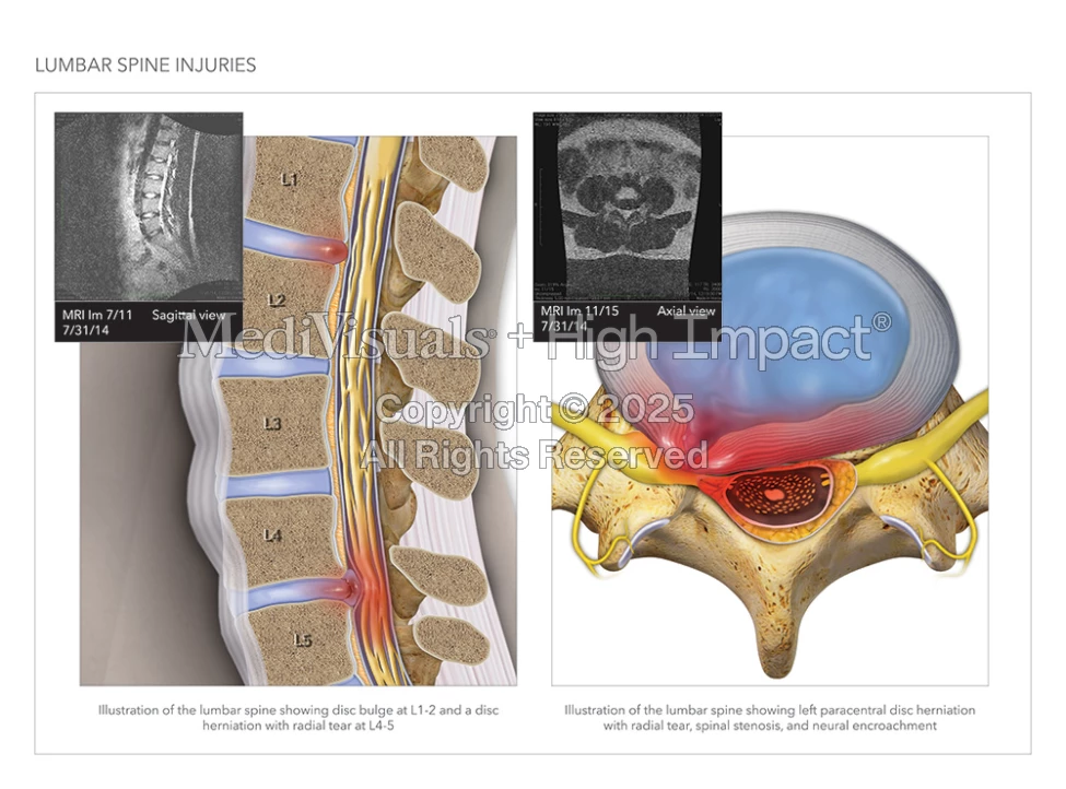 Medical Exhibit of Lower Back Injuries | MediVisuals + High Impact