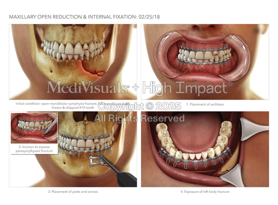 Maxillary Open Reduction Internal Fixation Medivisuals High Impact
