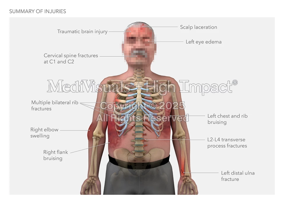 Trial Graphics: the Extent of Fatal Injuries | High Impact