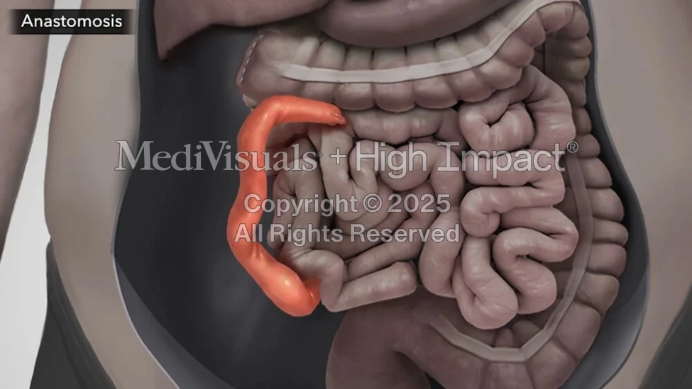 7-Figure Settlement: Animated Appendix Rupture After Botched ...
