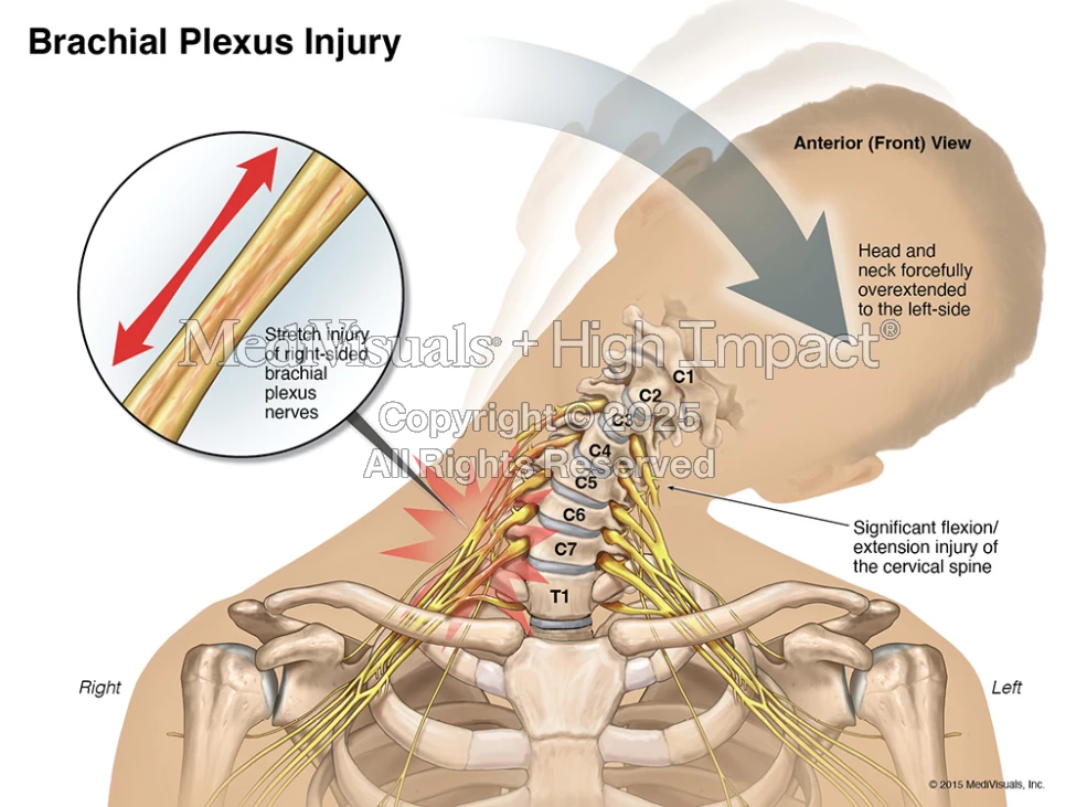 Brachial Plexus Injury