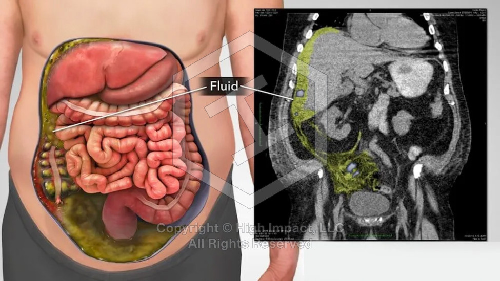7-Figure Settlement: Animated Appendix Rupture After Botched ...