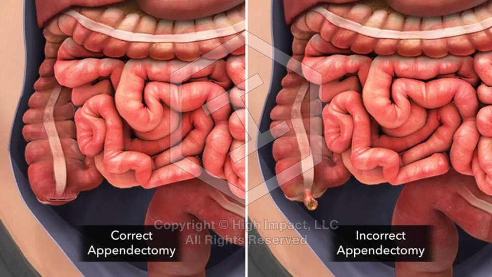 7-Figure Settlement: Animated Appendix Rupture After Botched ...