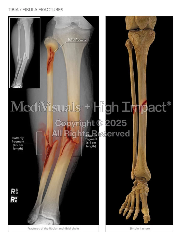 Tibia and Fibula Fractures | MediVisuals + High Impact