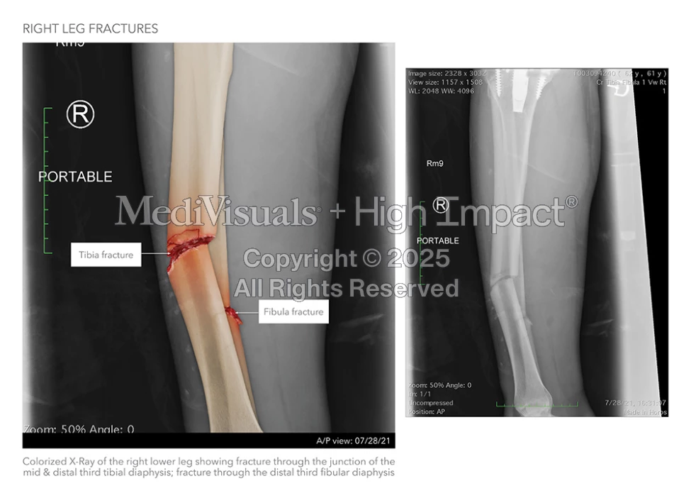 Animation and Illustration Shows Fall From Loading Dock Results in ...