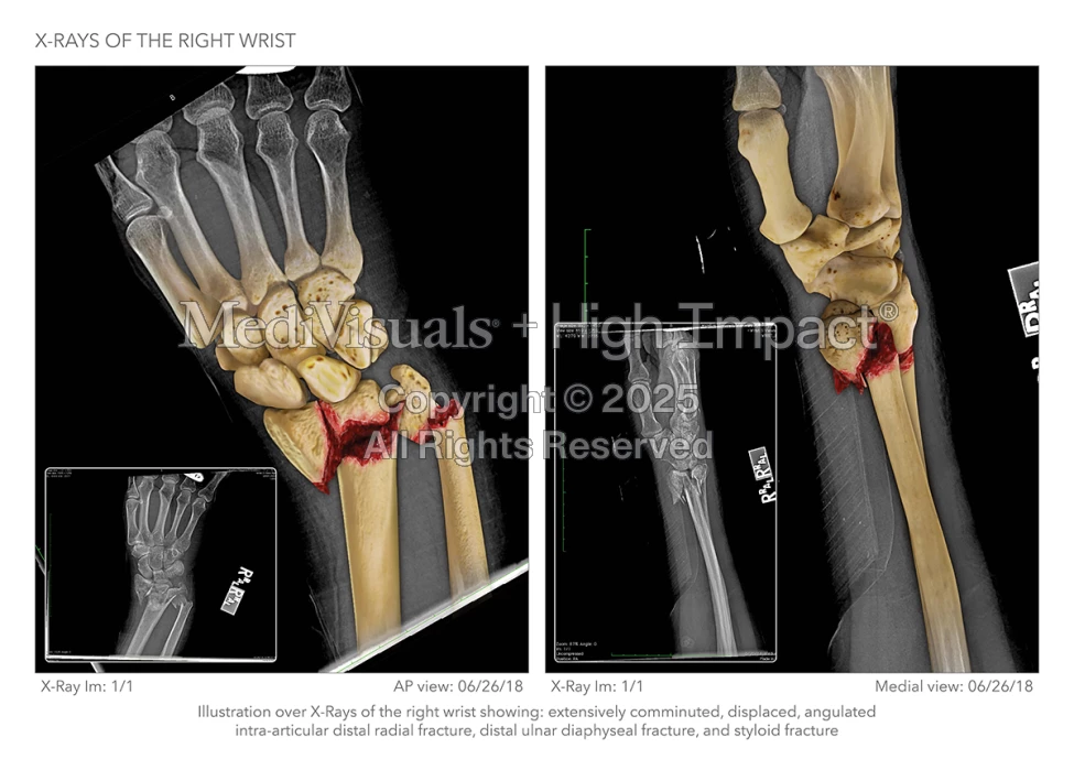 $525K Settlement: Illustrating Wrist Injury After Fall Down Stairs ...
