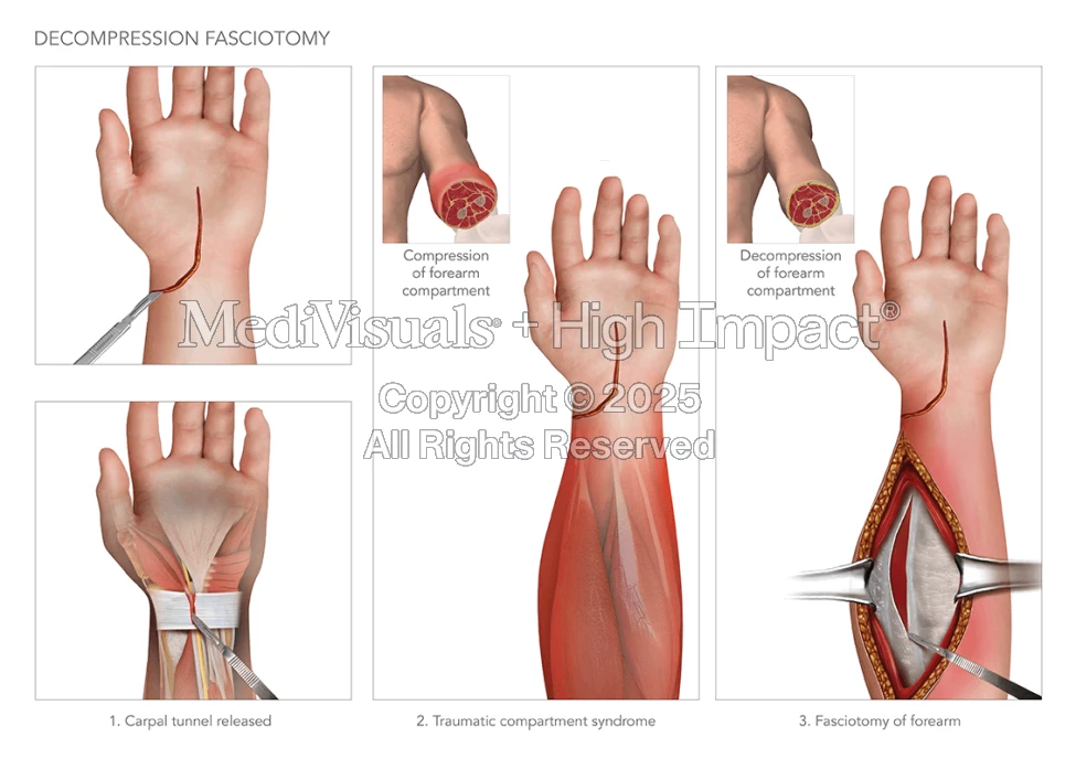 Decompression Fasciotomy | MediVisuals + High Impact
