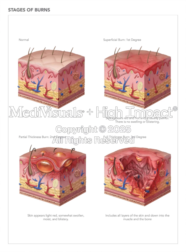 Stages Of Burns | MediVisuals + High Impact