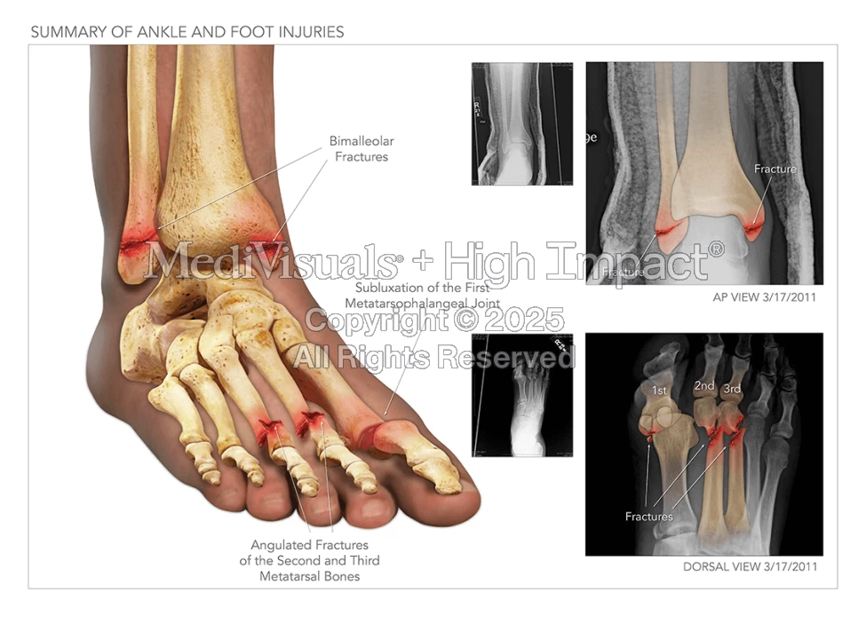 Summary of Ankle and Foot Injuries