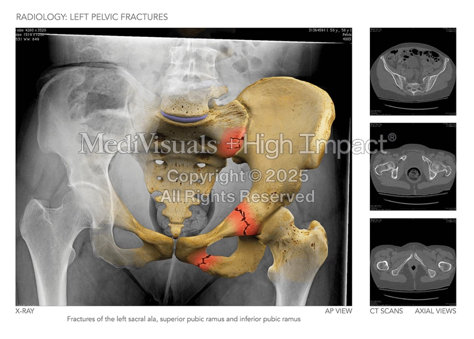 Pelvic Fracture Illustration | MediVisuals + High Impact