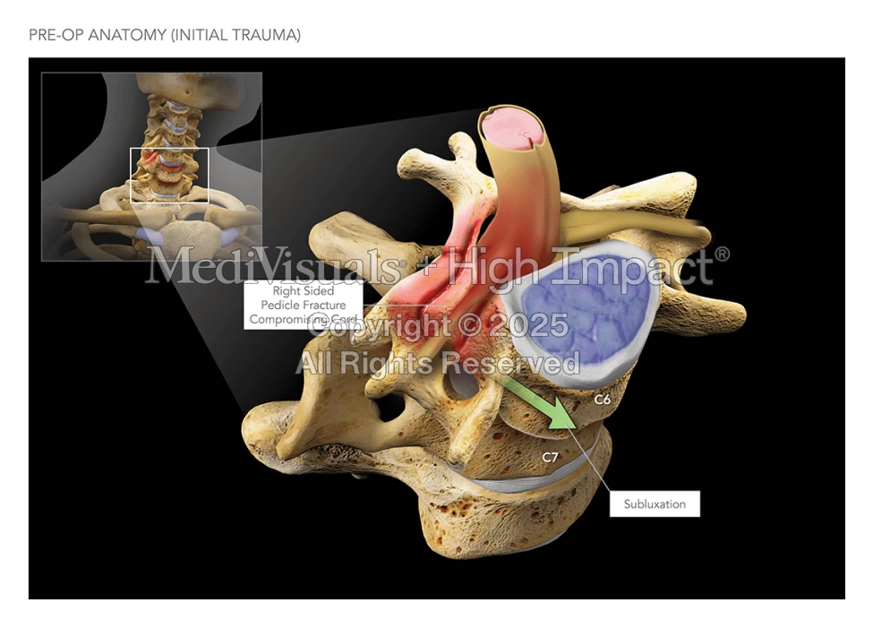 Cervical Spine Subluxation with Pedicle Fracture | MediVisuals + High ...
