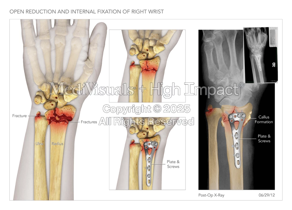 ORIF of Right Wrist | MediVisuals + High Impact