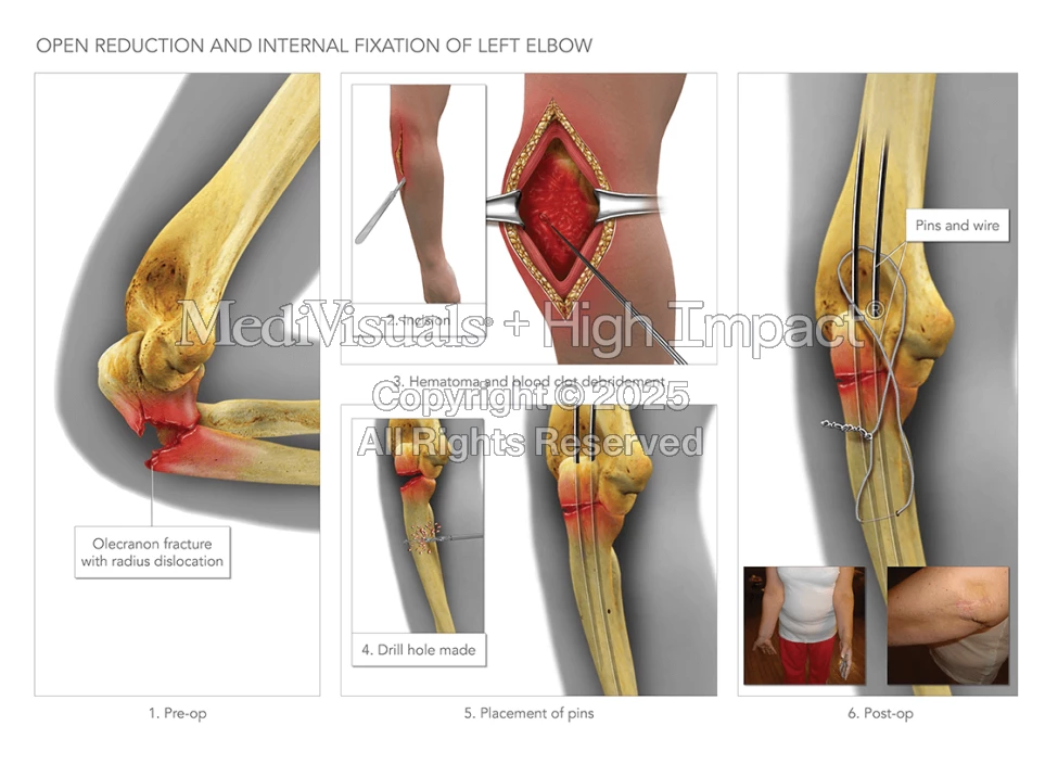 ORIF of Left Elbow | MediVisuals + High Impact