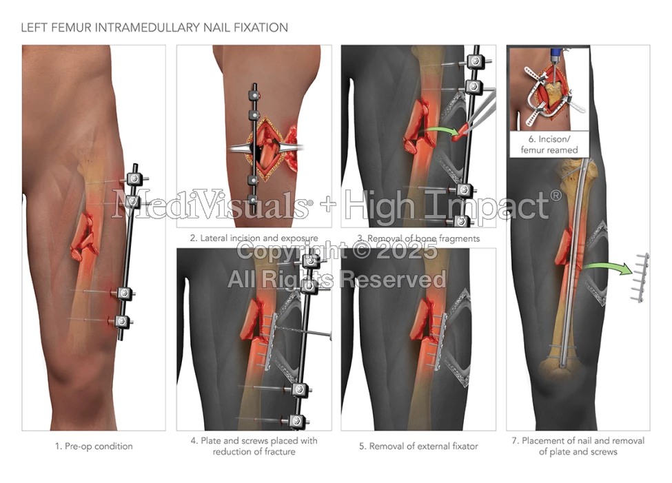 Left Femur Intramedullary Nail Fixation | MediVisuals + High Impact