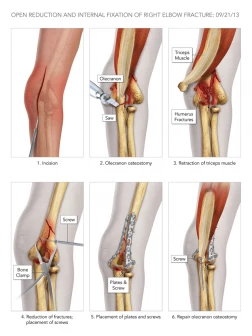 ORIF of Right Proximal Humerus Fracture | MediVisuals + High Impact