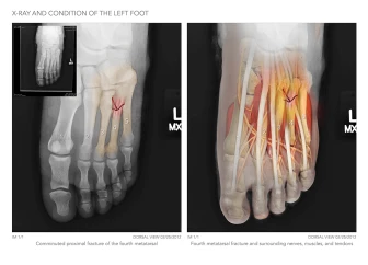 X-ray of the Left Foot | MediVisuals + High Impact