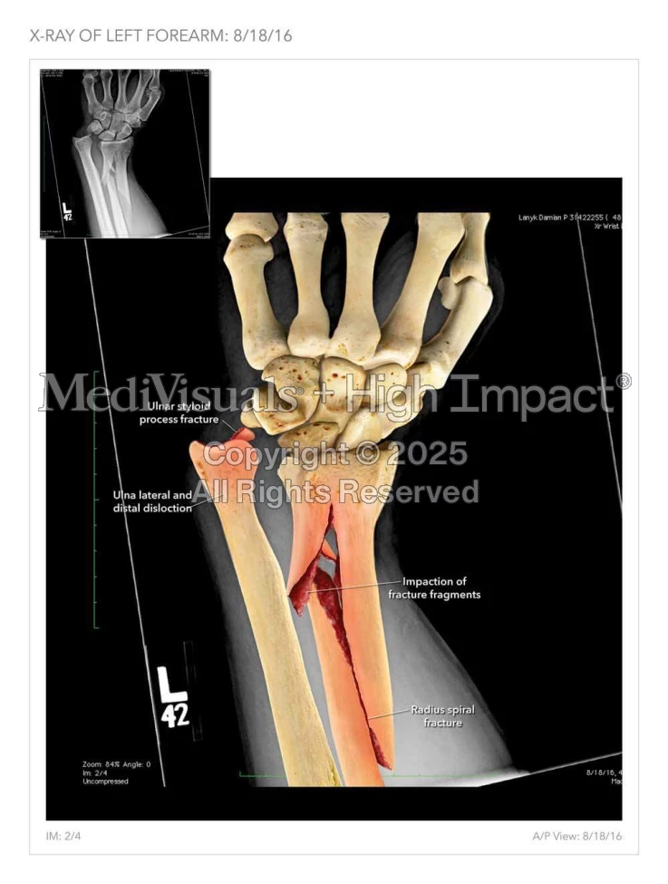 Left Forearm Fracture | MediVisuals + High Impact