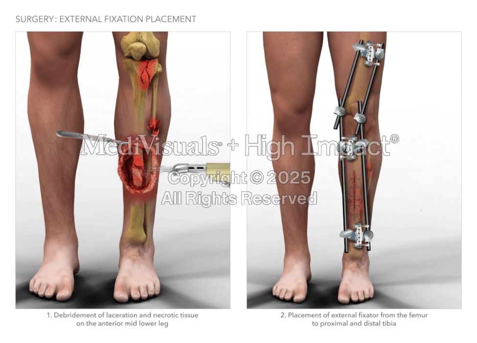 Lower Leg External Fixation | MediVisuals + High Impact
