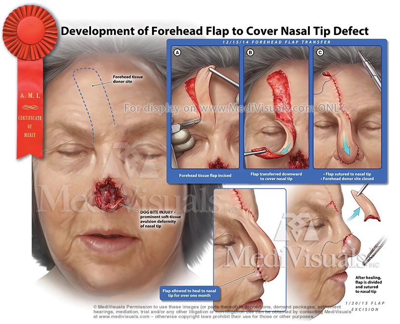 Development of Forehead Flap to Cover Nasal Tip Defect | MediVisuals ...