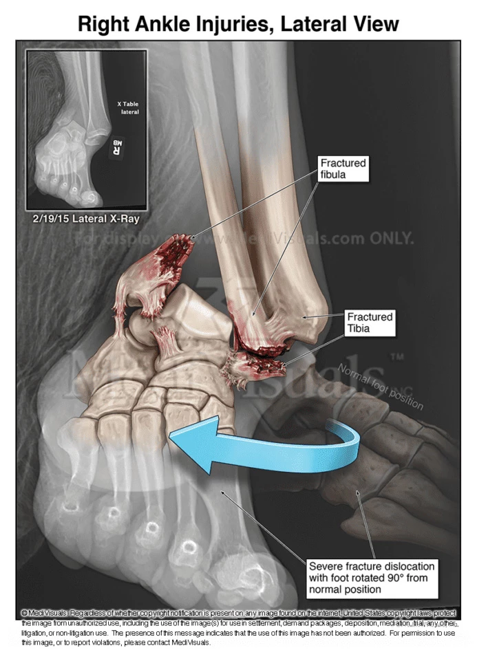 Right Ankle Injuries