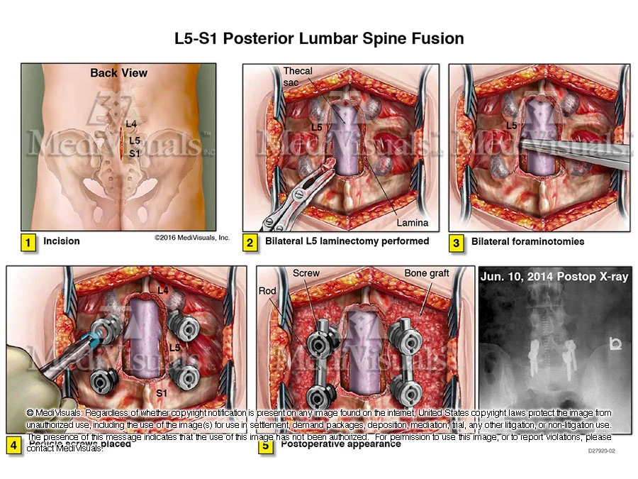 L5-S1 Posterior Lumbar Spine Fusion | MediVisuals + High Impact