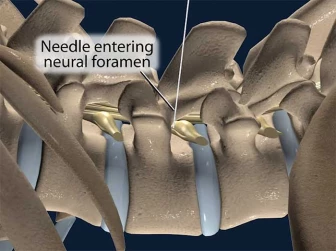 Epidural Injection: Cervical Transforaminal – light skin | MediVisuals ...