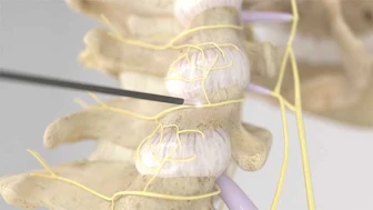 Radio Frequency Nerve Ablation Procedure (Rhizotomy) Lumbar Spine ...