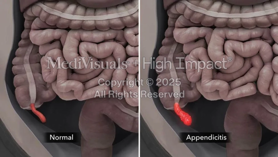 7-Figure Settlement: Animated Appendix Rupture After Botched ...