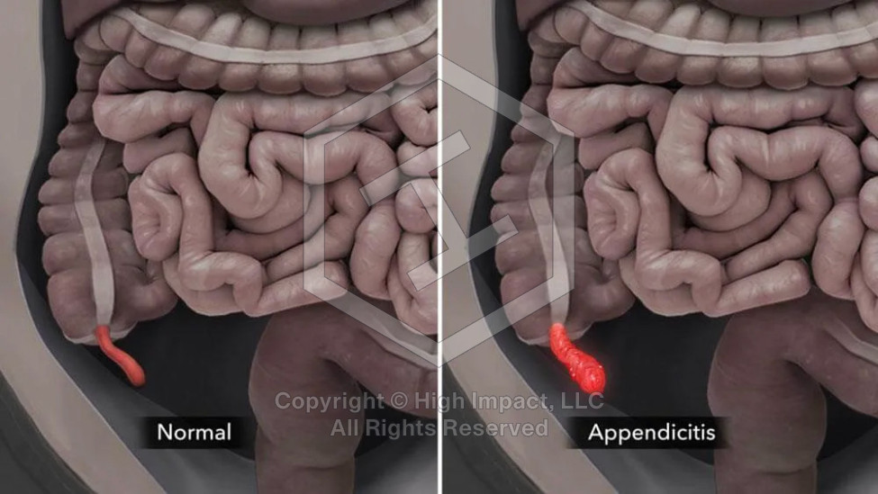 7-Figure Settlement: Animated Appendix Rupture After Botched Appendectomy | MediVisuals + High ...
