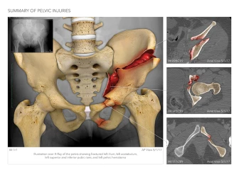 X-Ray and CT Scan Showing Complex Pelvic Injuries | MediVisuals + High ...