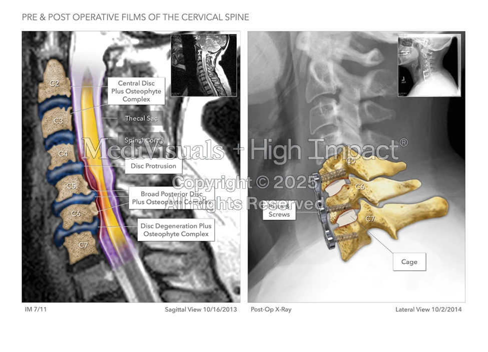 Trial Graphics - Spine Injuries | MediVisuals + High Impact
