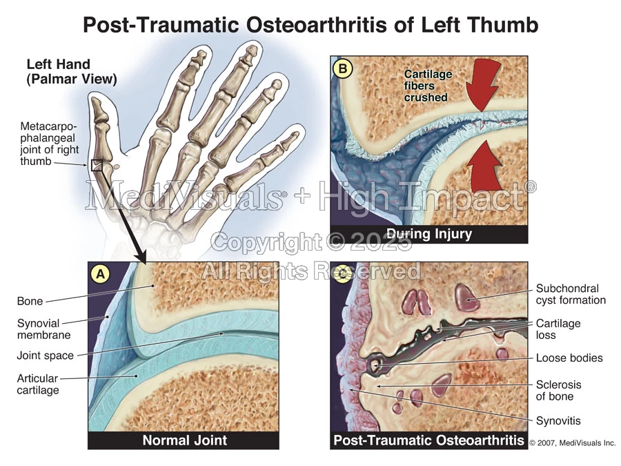 Post-Traumatic Osteoarthritis of Left Thumb