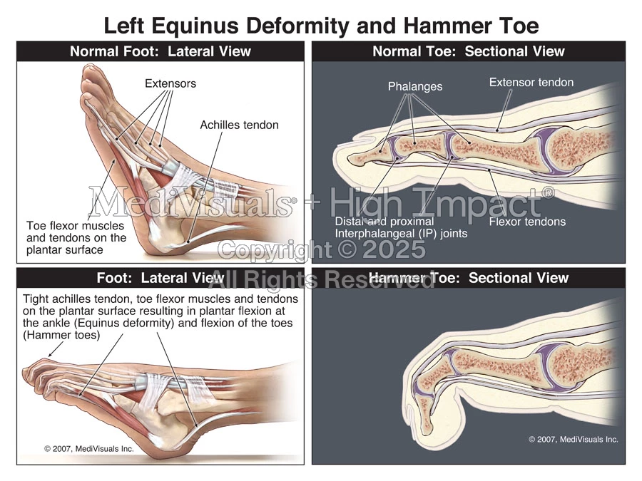 Left Equinus Deformity and Hammer Toe