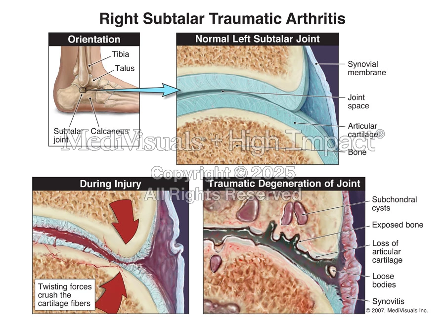 Right Ankle Traumatic Arthritis | MediVisuals + High Impact