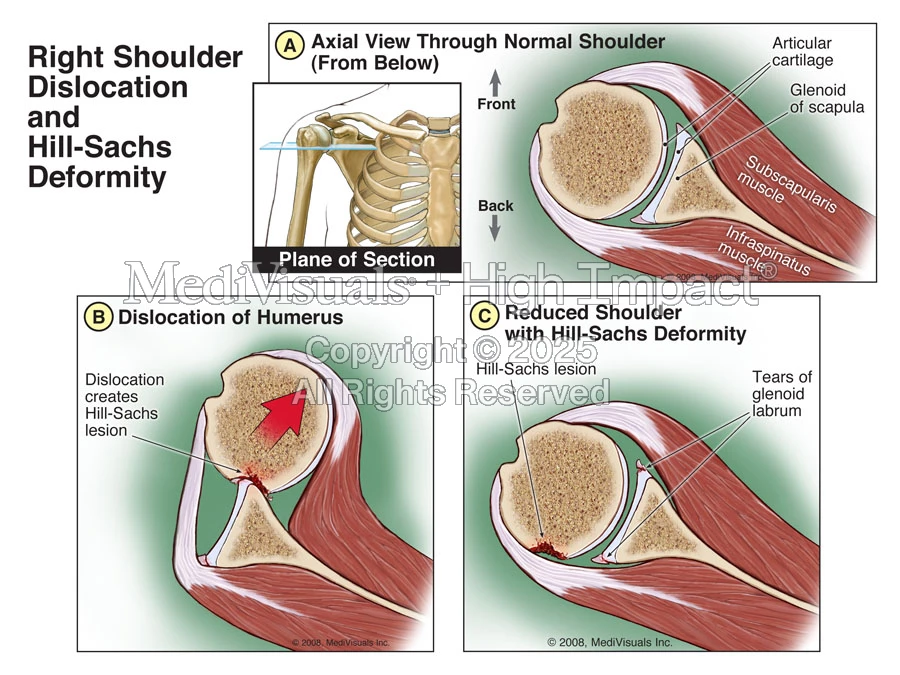 Right Shoulder Dislocation and Hill-Sachs Deformity | MediVisuals ...