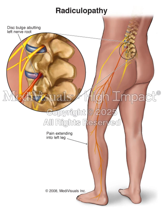 Lumbar Radiculopathy Medivisuals High Impact 0614