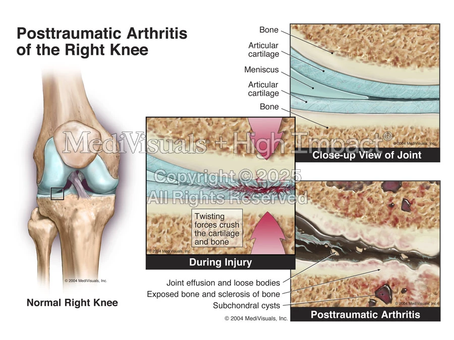 Post-Traumatic Arthritis of the Right Knee | MediVisuals + High Impact