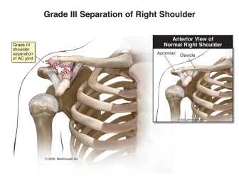 Grade III Separation of Left Shoulder | MediVisuals + High Impact