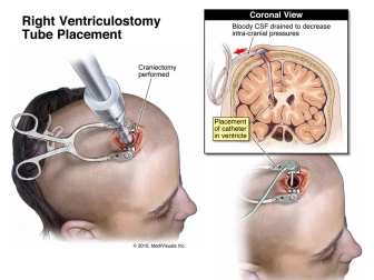 Right Ventriculoperitoneal Shunt Placement | MediVisuals + High Impact