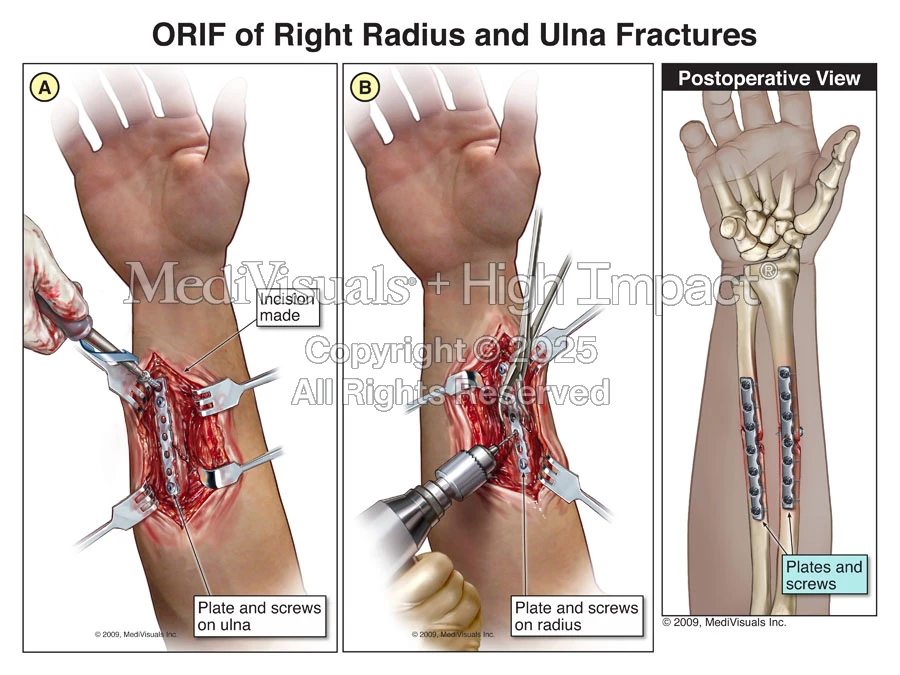 ORIF of Right Radius and Ulna Fractures | MediVisuals + High Impact