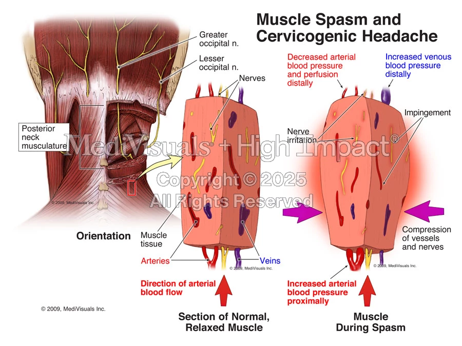 Muscle Spasm and Cervicogenic Headache